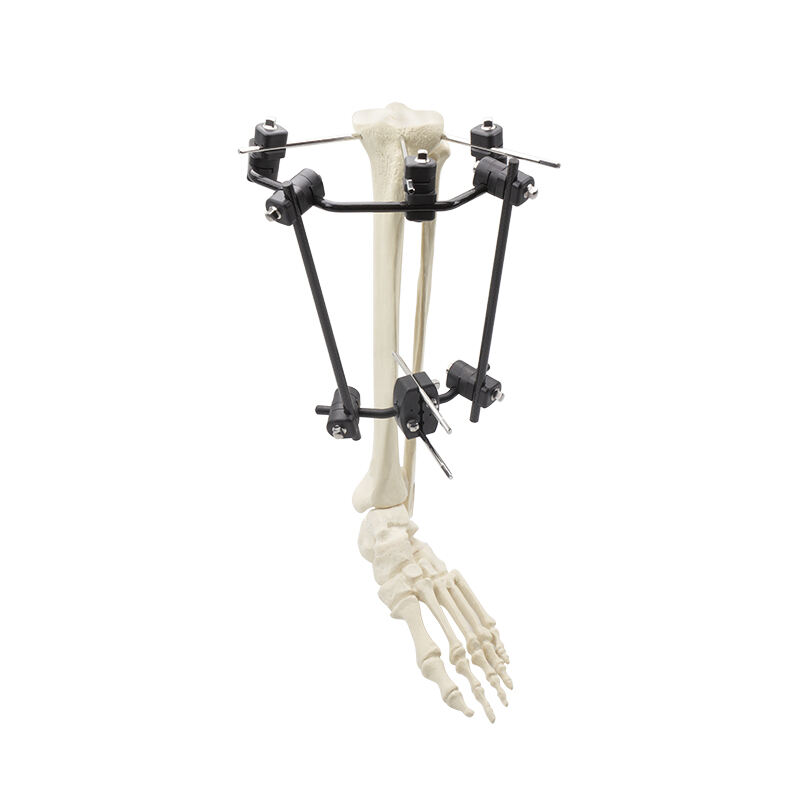 φ8.0 Série Fixation Externe Fixateur – Tibia Proximal Cadre Semicirculaire | Fixation Externe